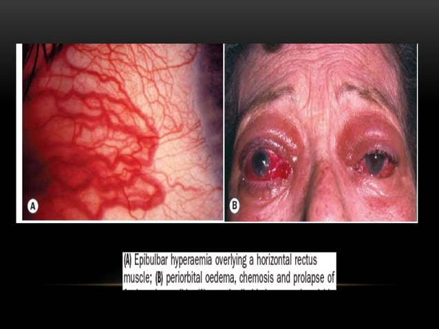 Proptosis | PPTX | Eye and Vision Conditions | Diseases and Conditions