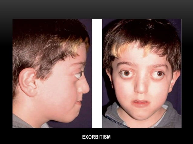 Proptosis | PPTX | Eye and Vision Conditions | Diseases and Conditions