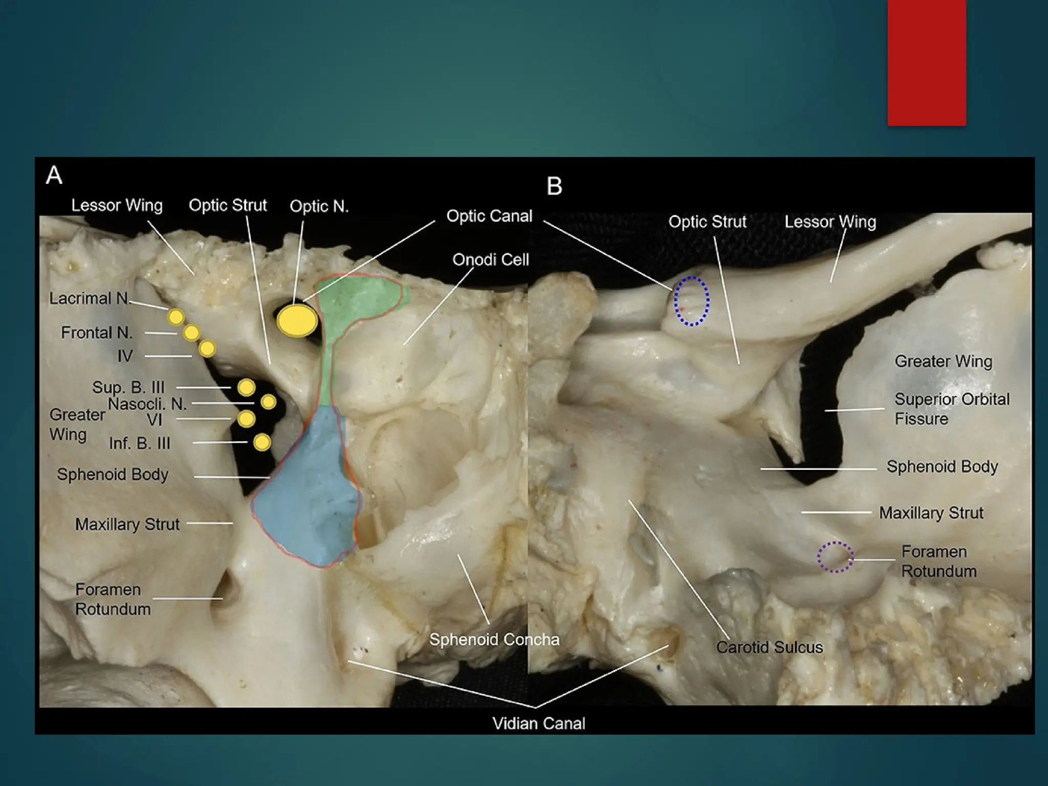 proptosis cavernous sinus thrombosis class h (1).pptx