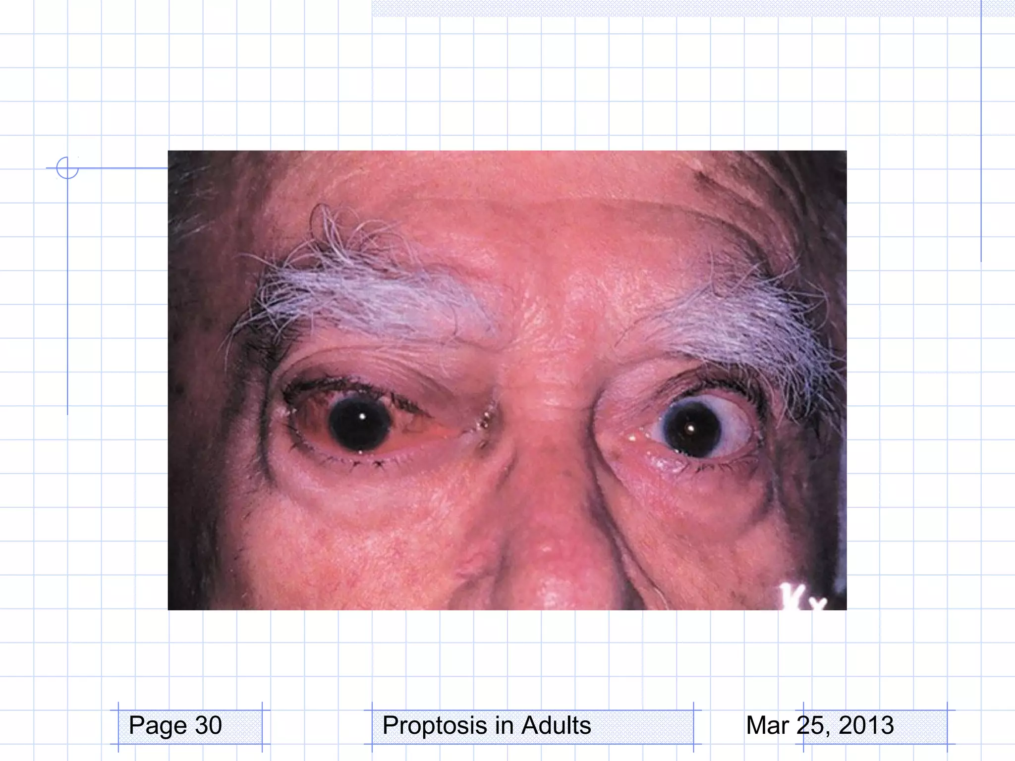 Proptosis in adults | PPT