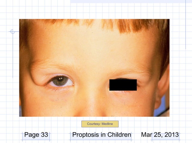 Proptosis in children | PPT
