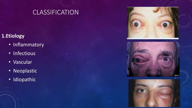 proptosis | PPTX | Eye and Vision Conditions | Diseases and Conditions