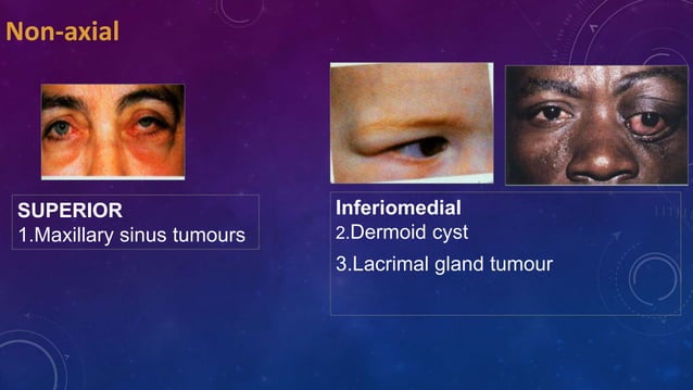 proptosis | PPTX | Eye and Vision Conditions | Diseases and Conditions