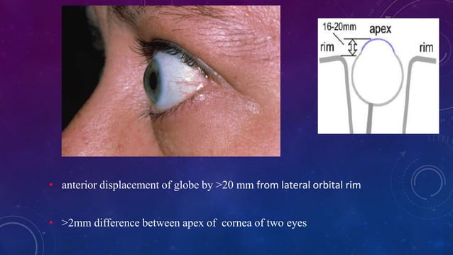 proptosis | PPTX | Eye and Vision Conditions | Diseases and Conditions