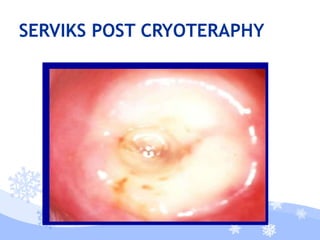 Tata cara PROSEDUR CRYOTHERAPY translate.pptx