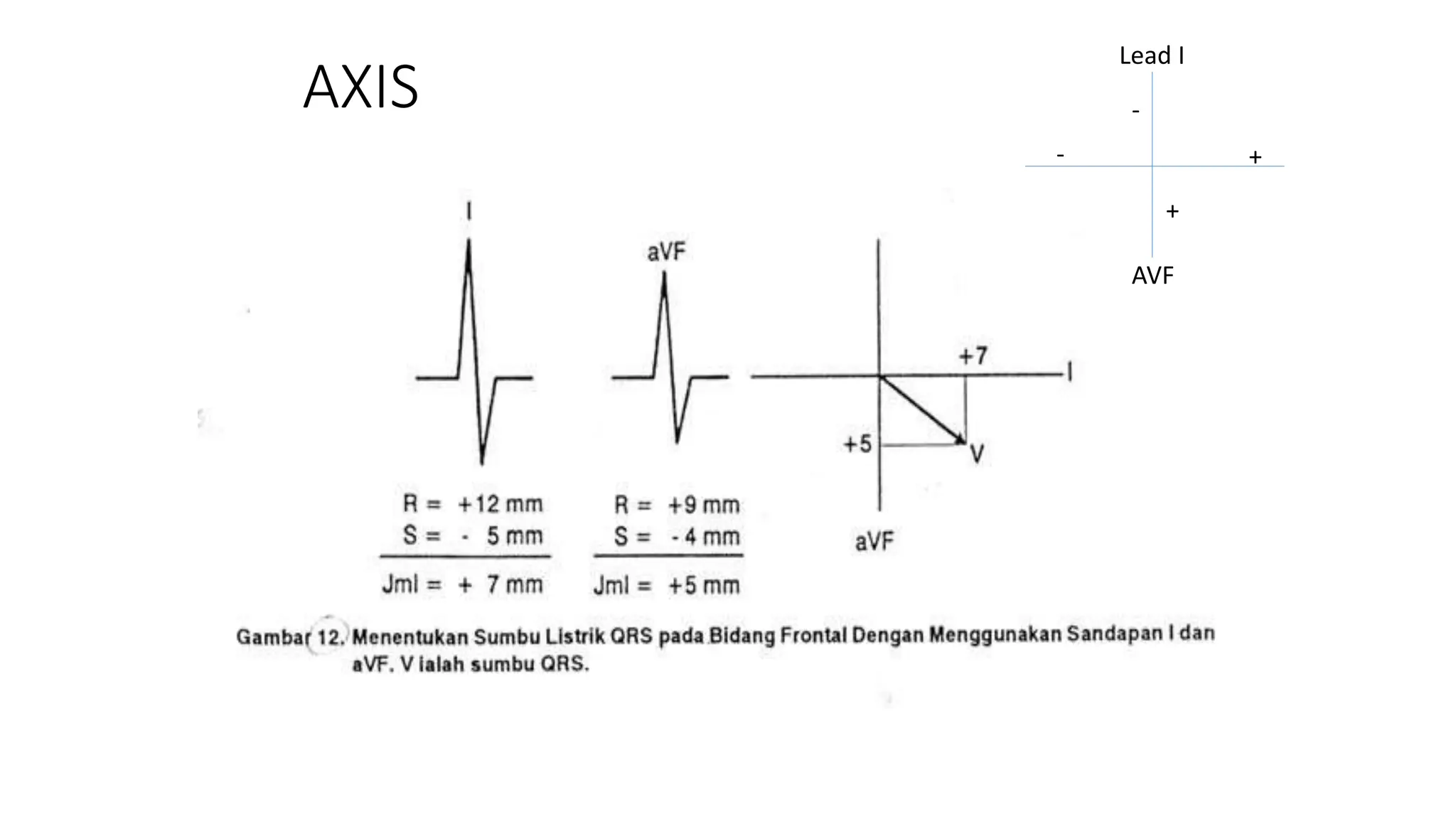 PROSEDUR PEMASANGAN EKG PADA KEPERAWATAN.pptx