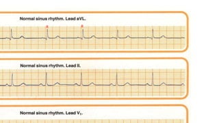PROSEDUR PEMASANGAN EKG PADA KEPERAWATAN.pptx