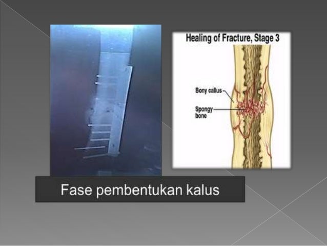 Proses penyembuhan fraktur