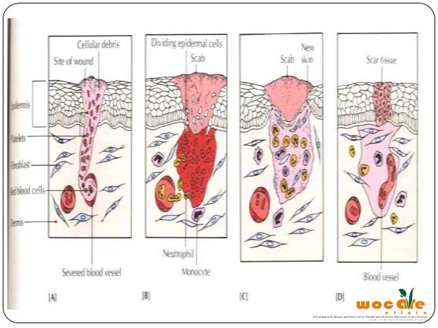 Proses penyembuhan luka