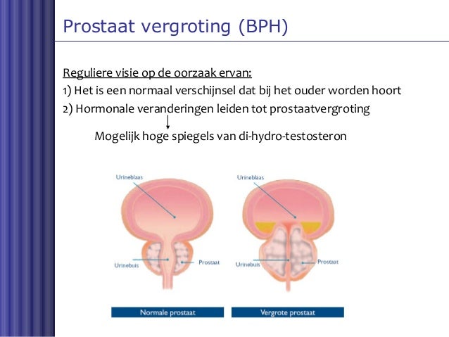 Prostaat Klachten