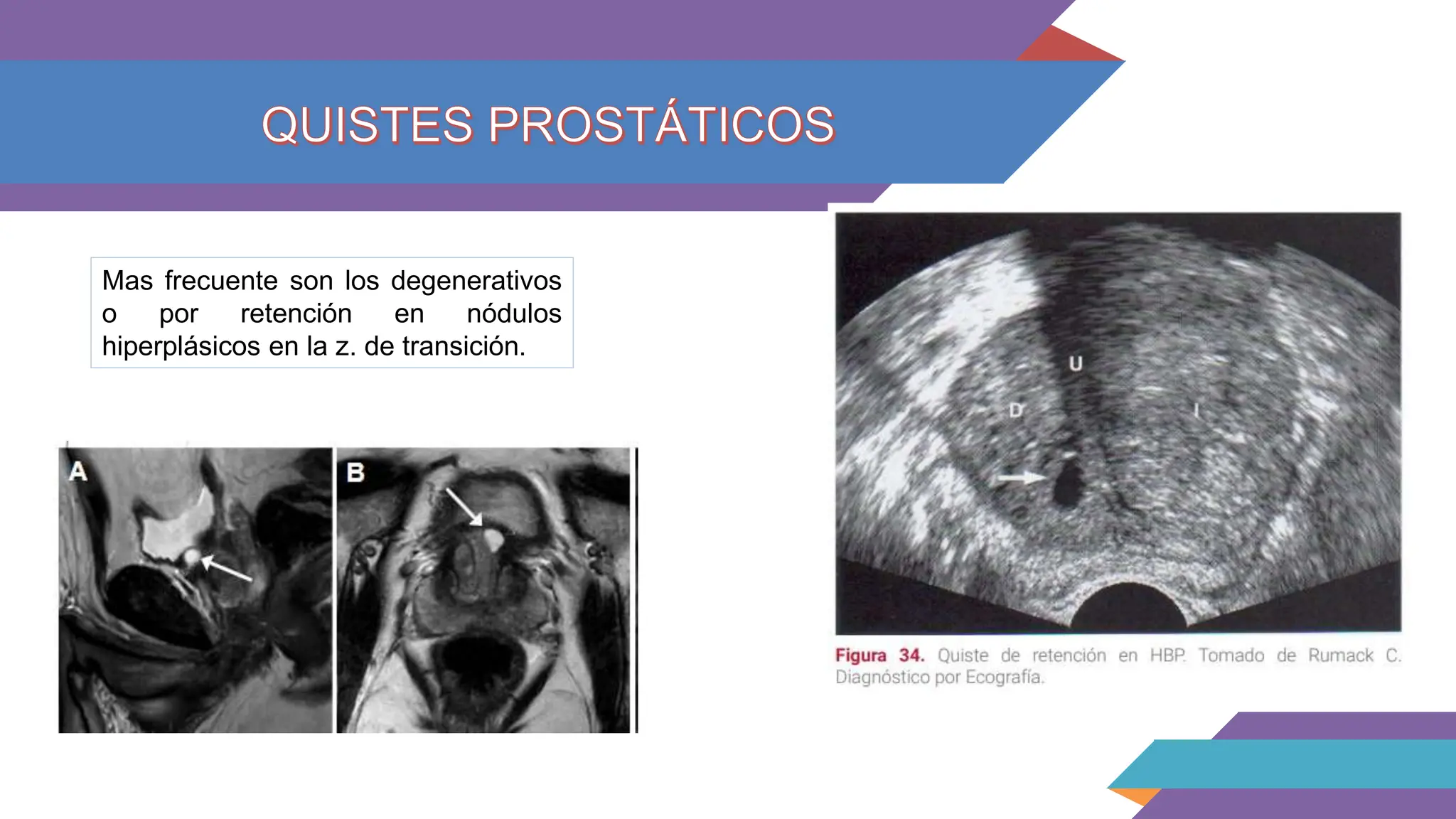 PROSTATA.pptx ecografia de prostata imagenologia | PPTX
