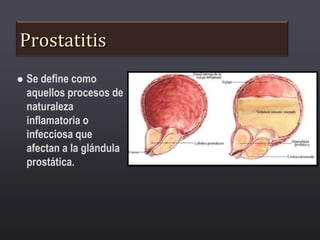 PATOLOGIAS DE LA PROSTATA - PROSTATITIS | PPTX