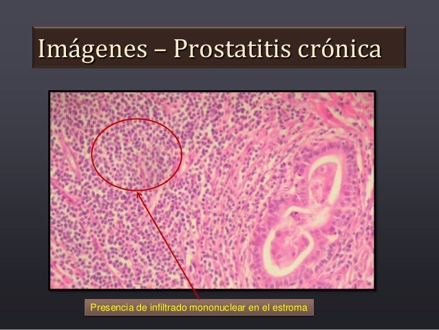 PATOLOGIAS DE LA PROSTATA - PROSTATITIS
