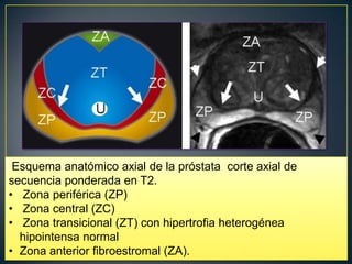 Prostata (Hiperplasia, Carcinoma) Metodos Diagnosticos | PPTX