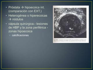 Prostata (Hiperplasia, Carcinoma) Metodos Diagnosticos | PPTX