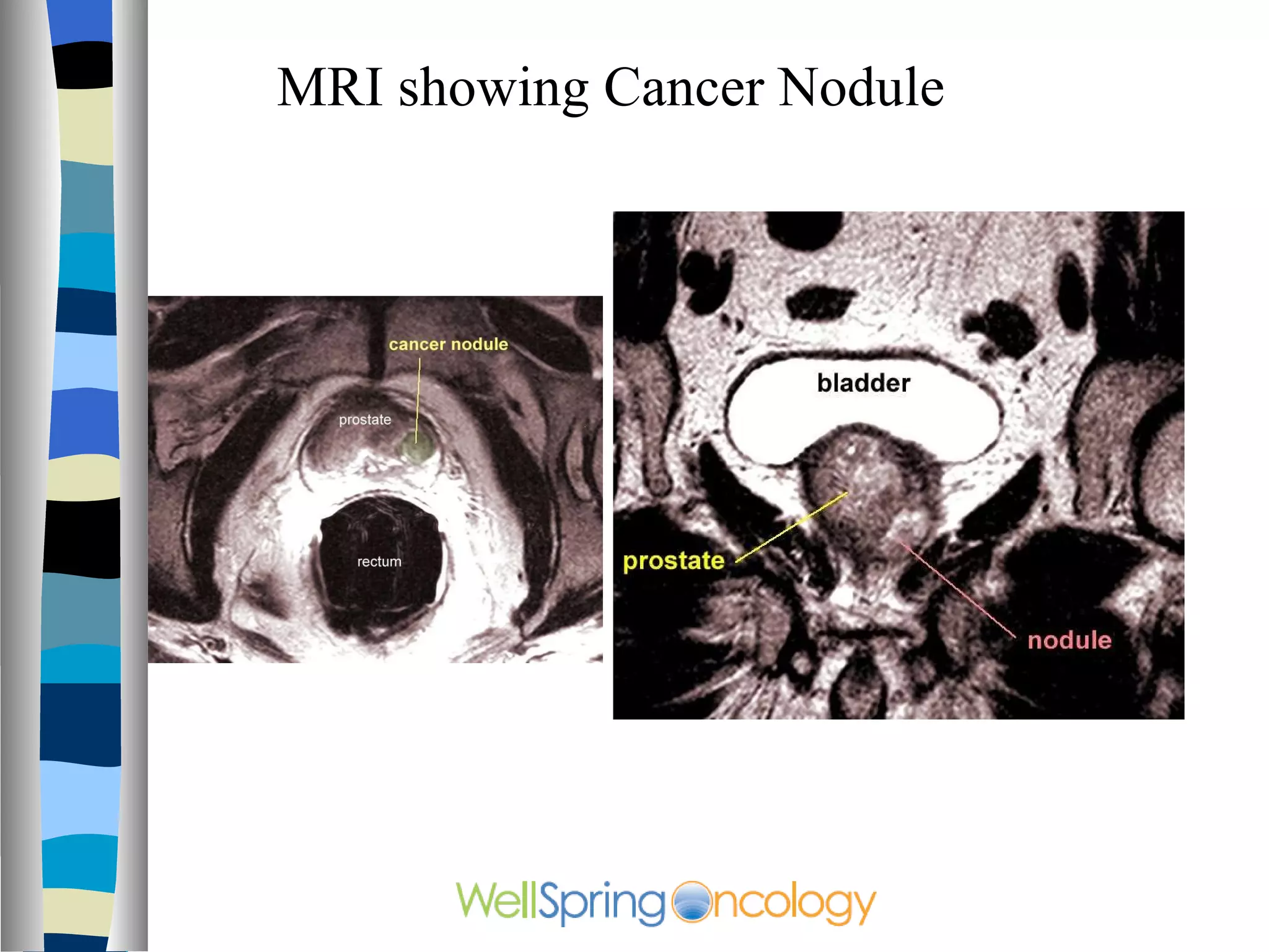 Prostate Cancer | PPT