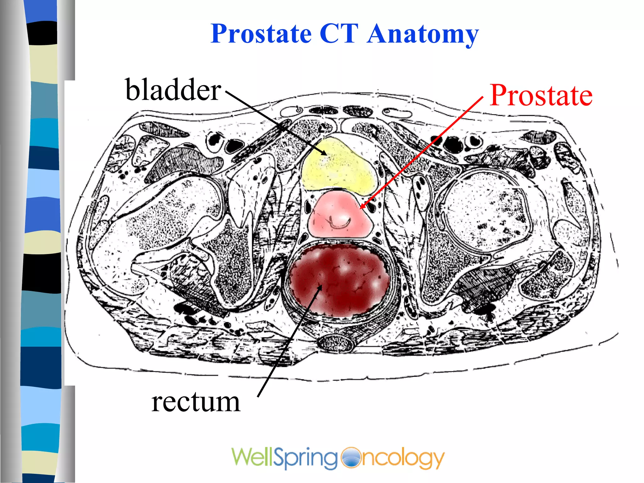 Prostate Cancer | PPT