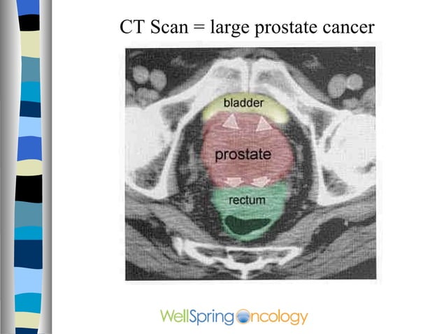 Prostate Cancer | PPT | Cancer | Diseases and Conditions