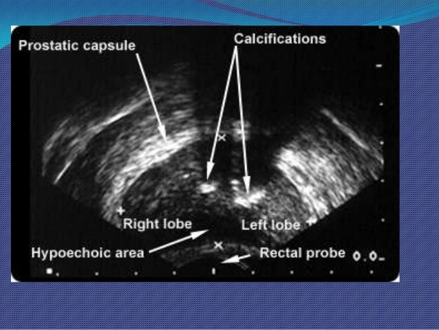 Surgical Anatomy of Prostate