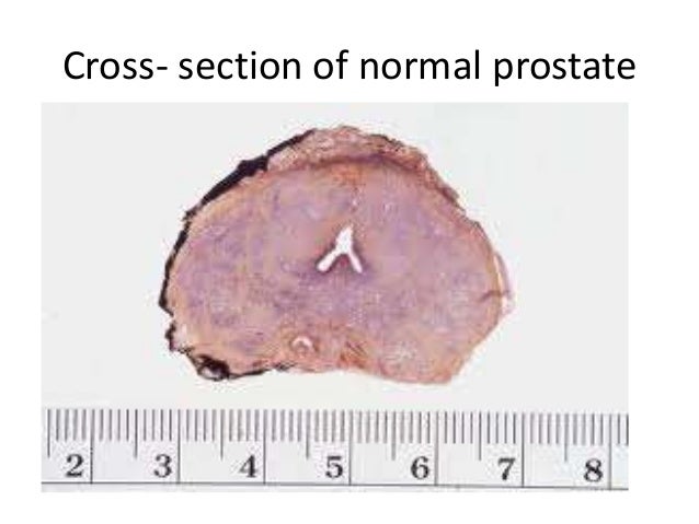 Prostate and Erectile Dysfunction and other common male reproductive