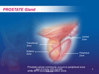 Prostate BPH- evaluation & management | PDF
