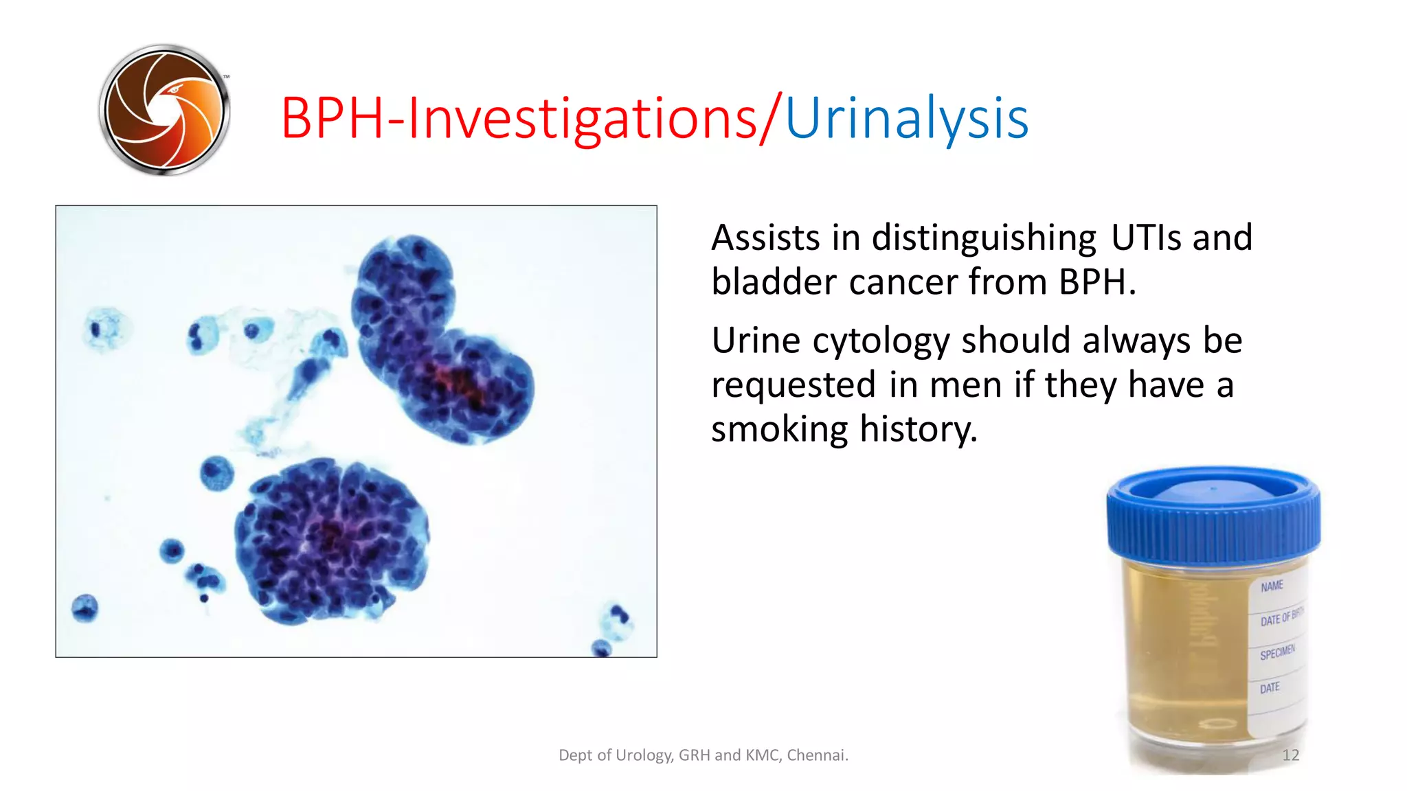Prostate Benign Prostatic Hyperplasia(BPH)- overview | PDF