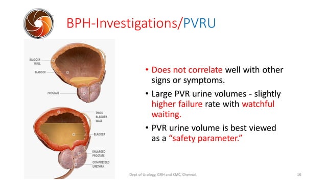 Prostate Benign Prostatic Hyperplasia(BPH)- overview | PDF | Sexual ...