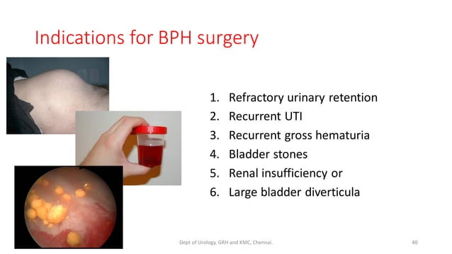 Prostate Benign Prostatic Hyperplasia(BPH)- overview | PDF | Sexual ...
