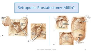 Prostate Benign Prostatic Hyperplasia(BPH)- overview | PDF