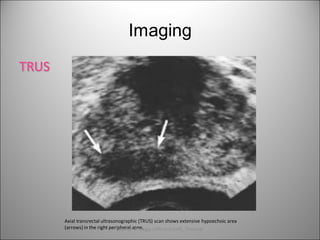 Prostate carcinoma- diagnosis and staging | PDF