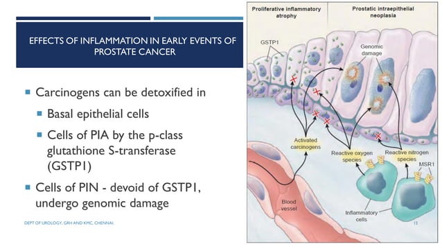 Prostate carcinoma- etiopathogenesis | PDF | Endocrine and Metabolic ...