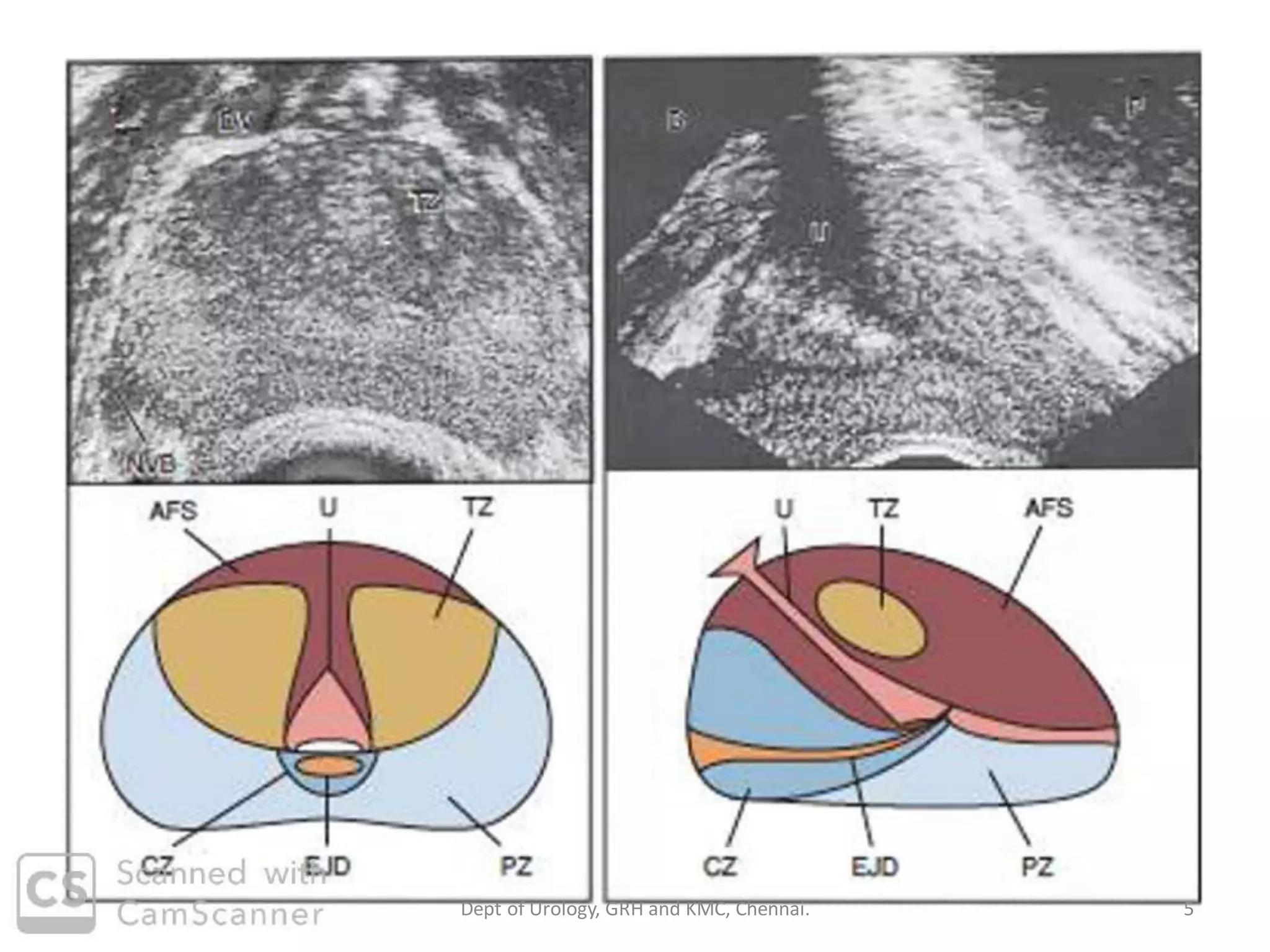 Prostate carcinoma- imaging | PDF
