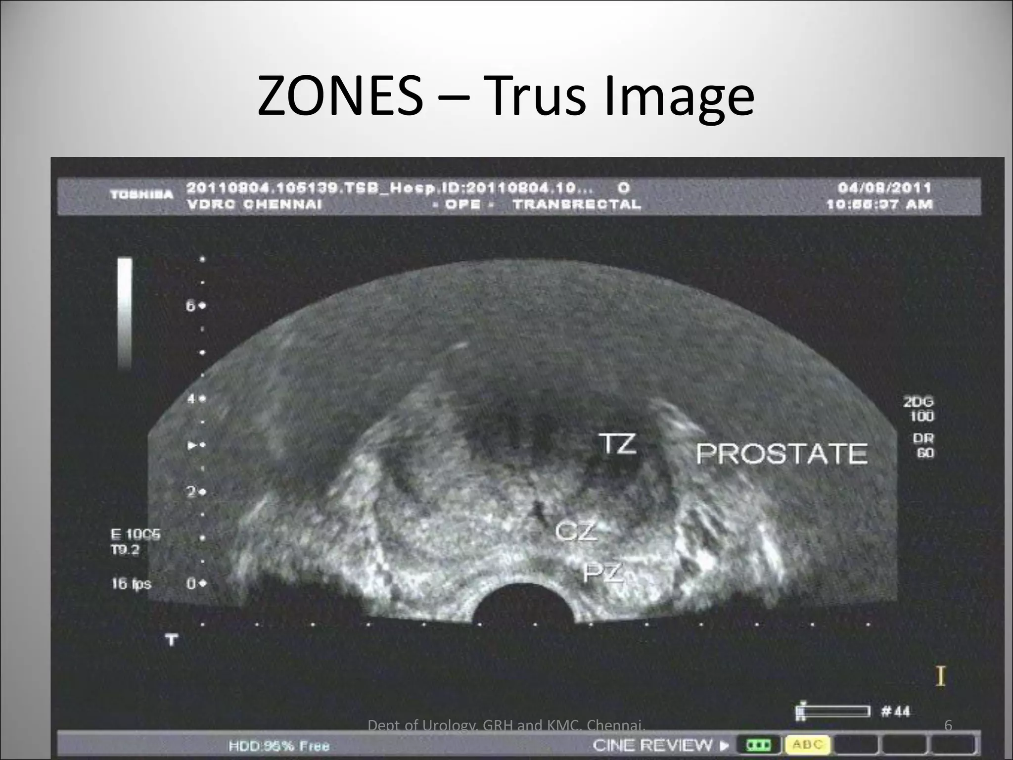Prostate carcinoma- imaging | PDF