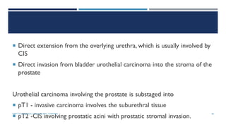 Prostate carcinoma- pathology and staging | PDF