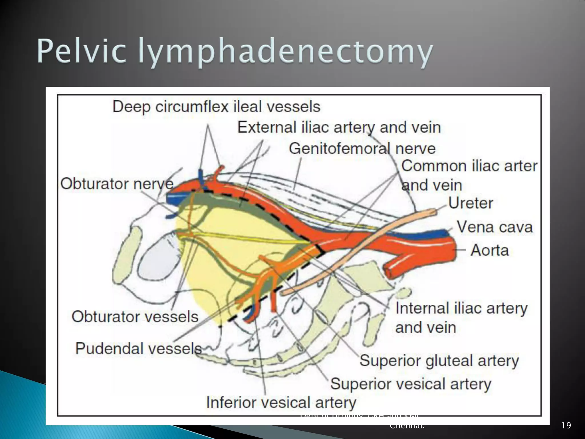 Prostate carinoma- surgery- Open Radical Retropubic Prostatectomy(rrp ...