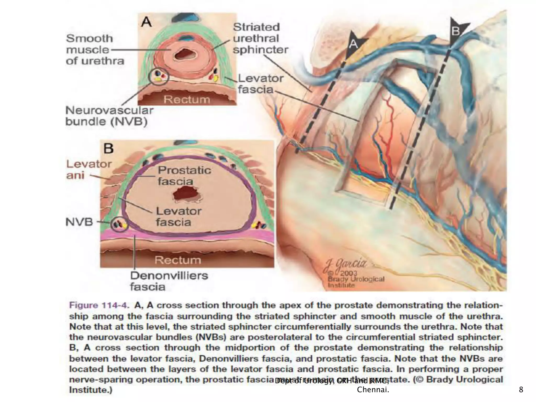 Prostate carinoma- surgery- Open Radical Retropubic Prostatectomy(rrp ...