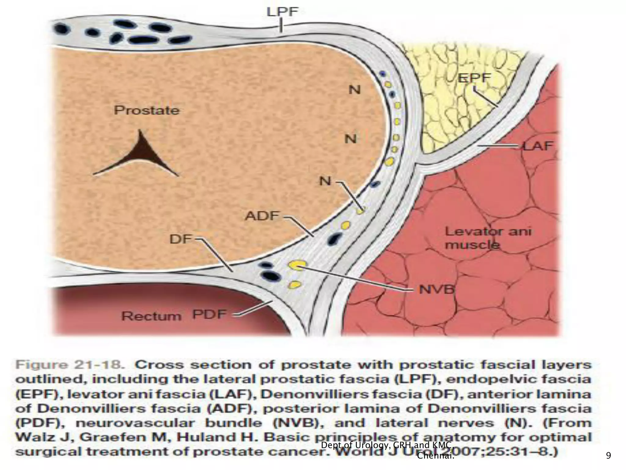 Prostate carinoma- surgery- Open Radical Retropubic Prostatectomy(rrp ...