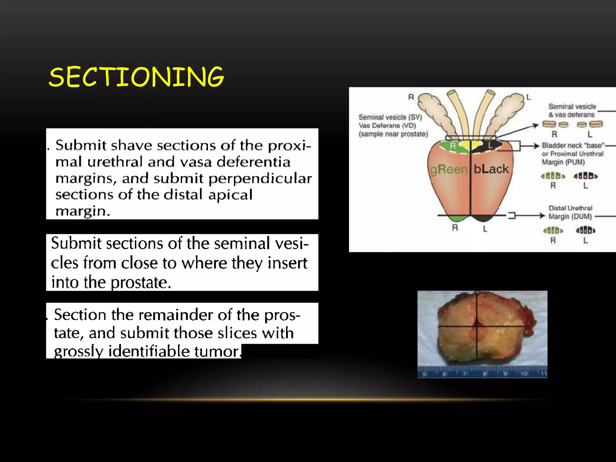 Prostate grossing and reporting | PPTX
