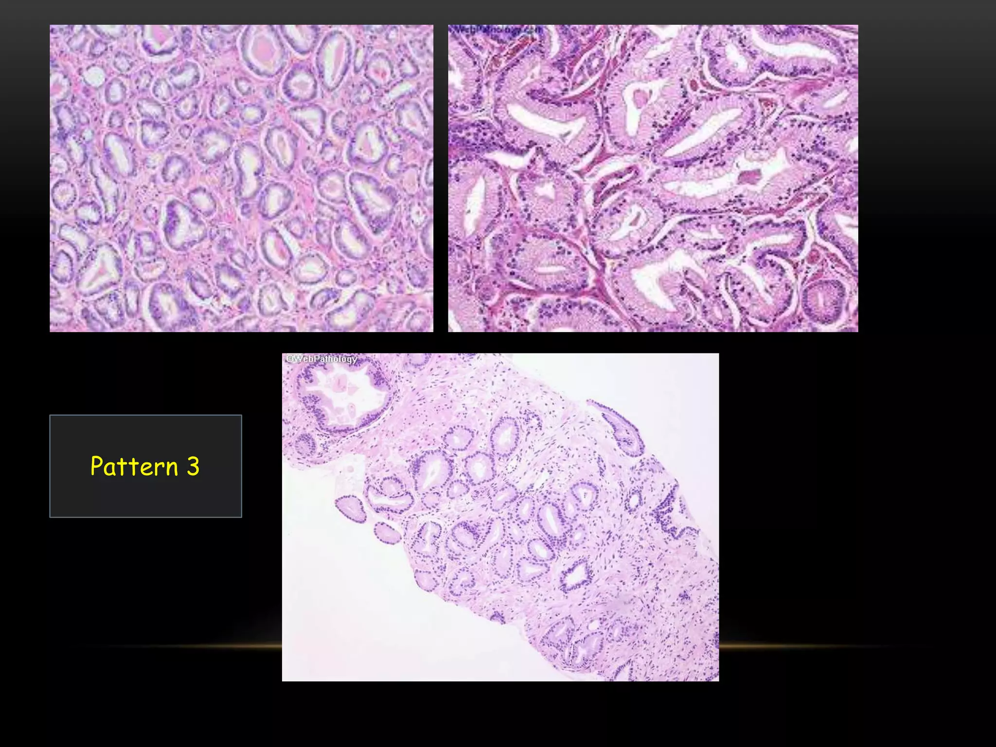 Prostate grossing and reporting | PPTX