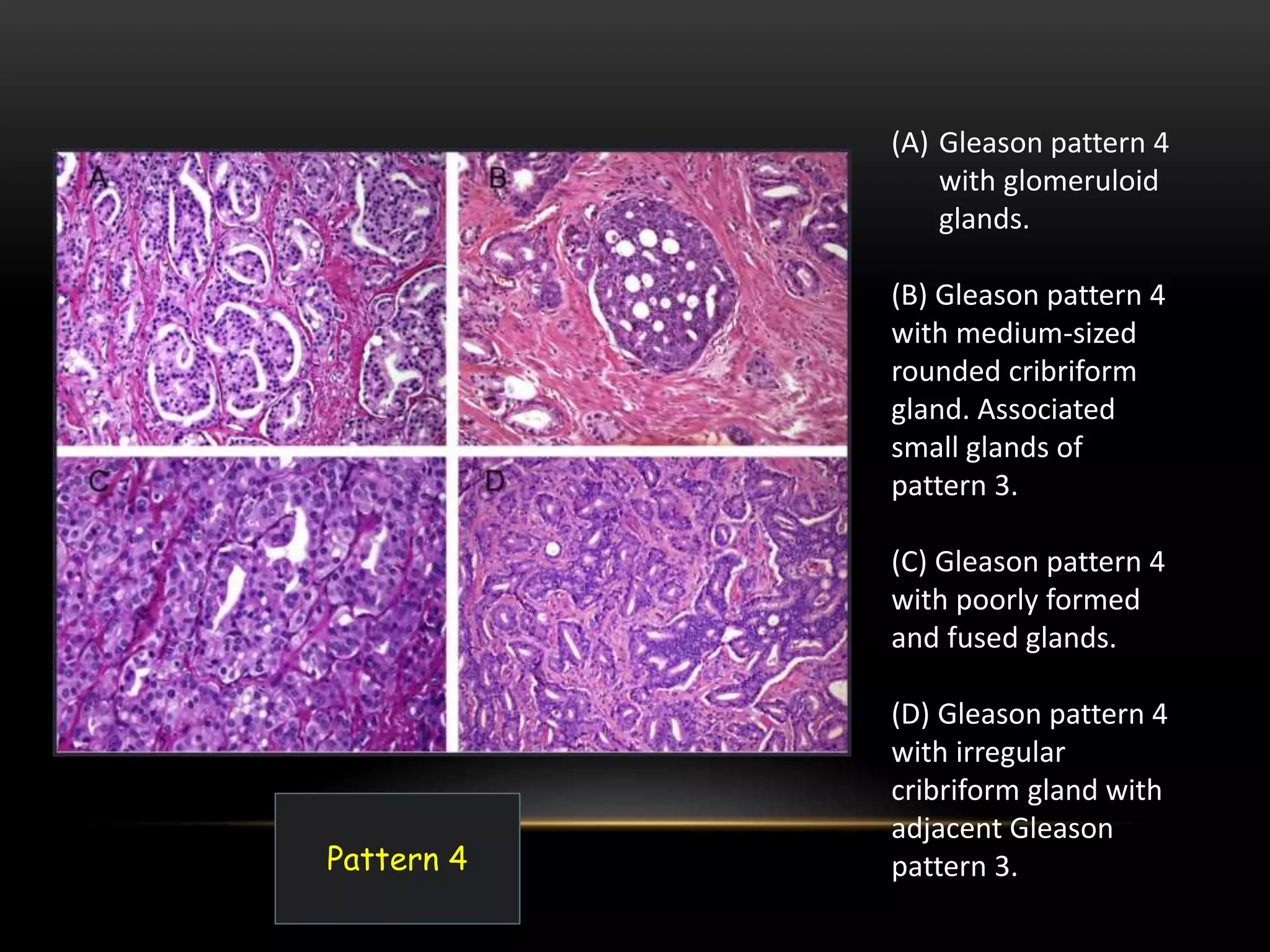 Prostate grossing and reporting | PPTX