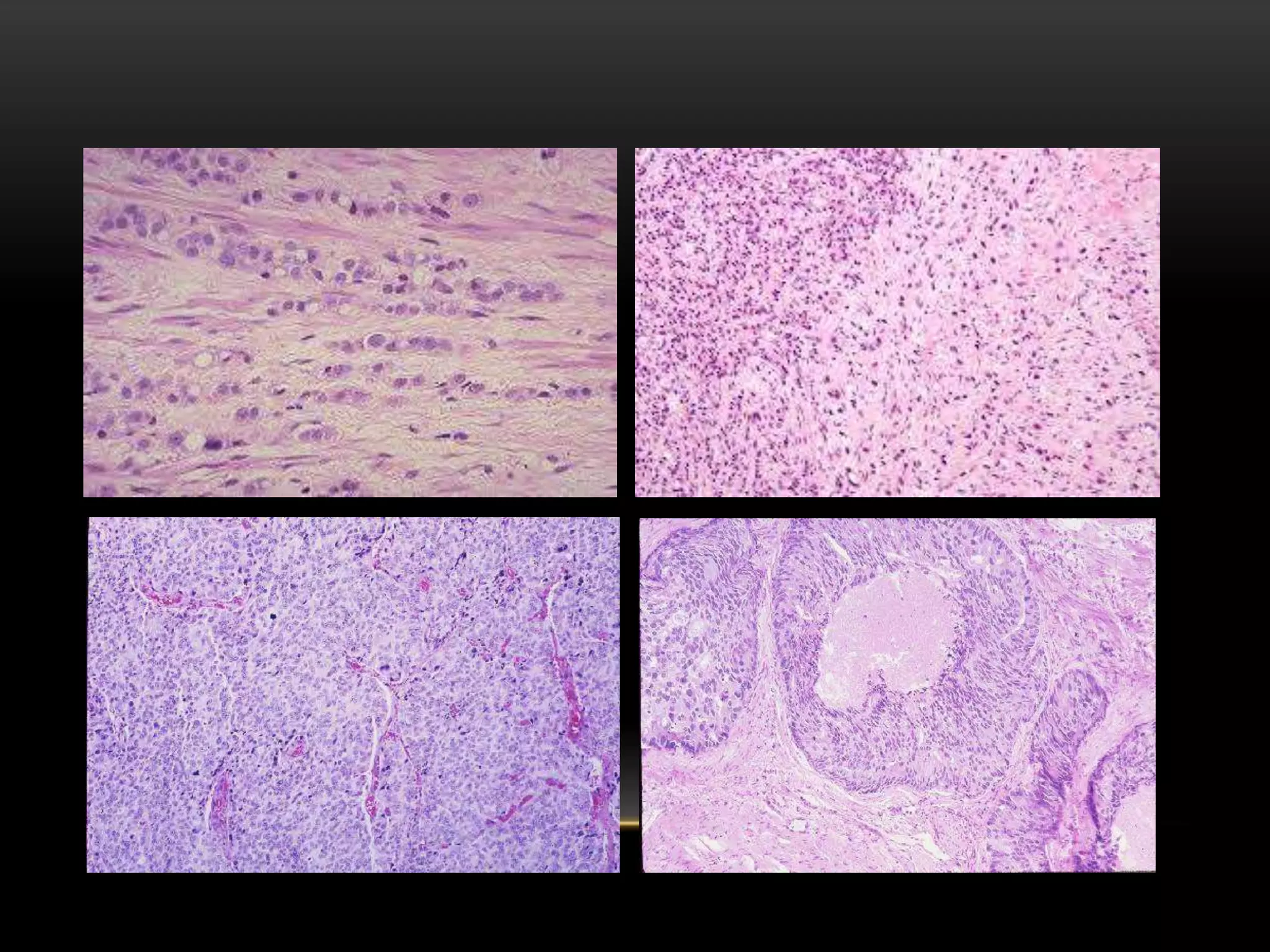 Prostate grossing and reporting | PPTX