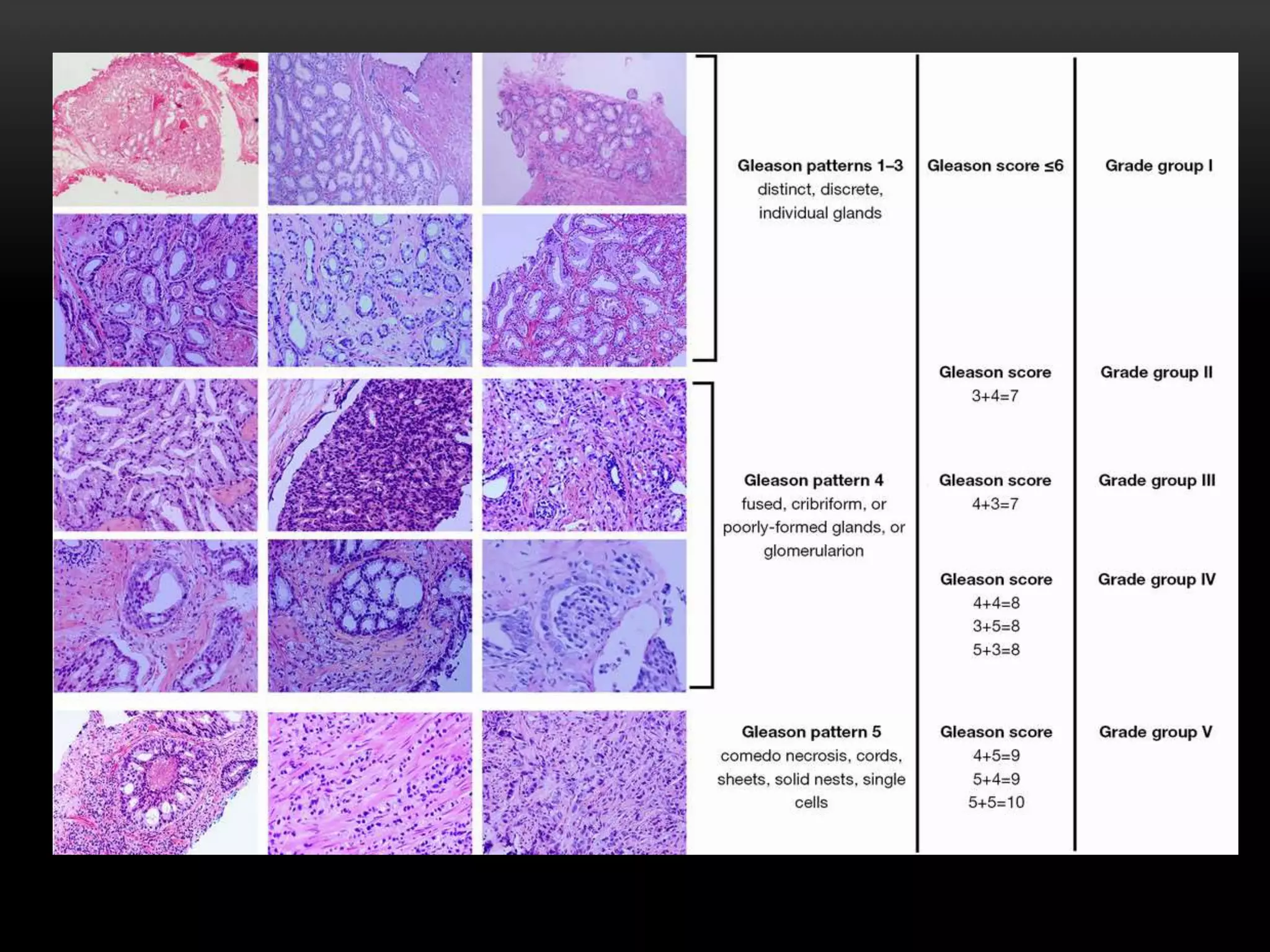 Prostate grossing and reporting | PPTX