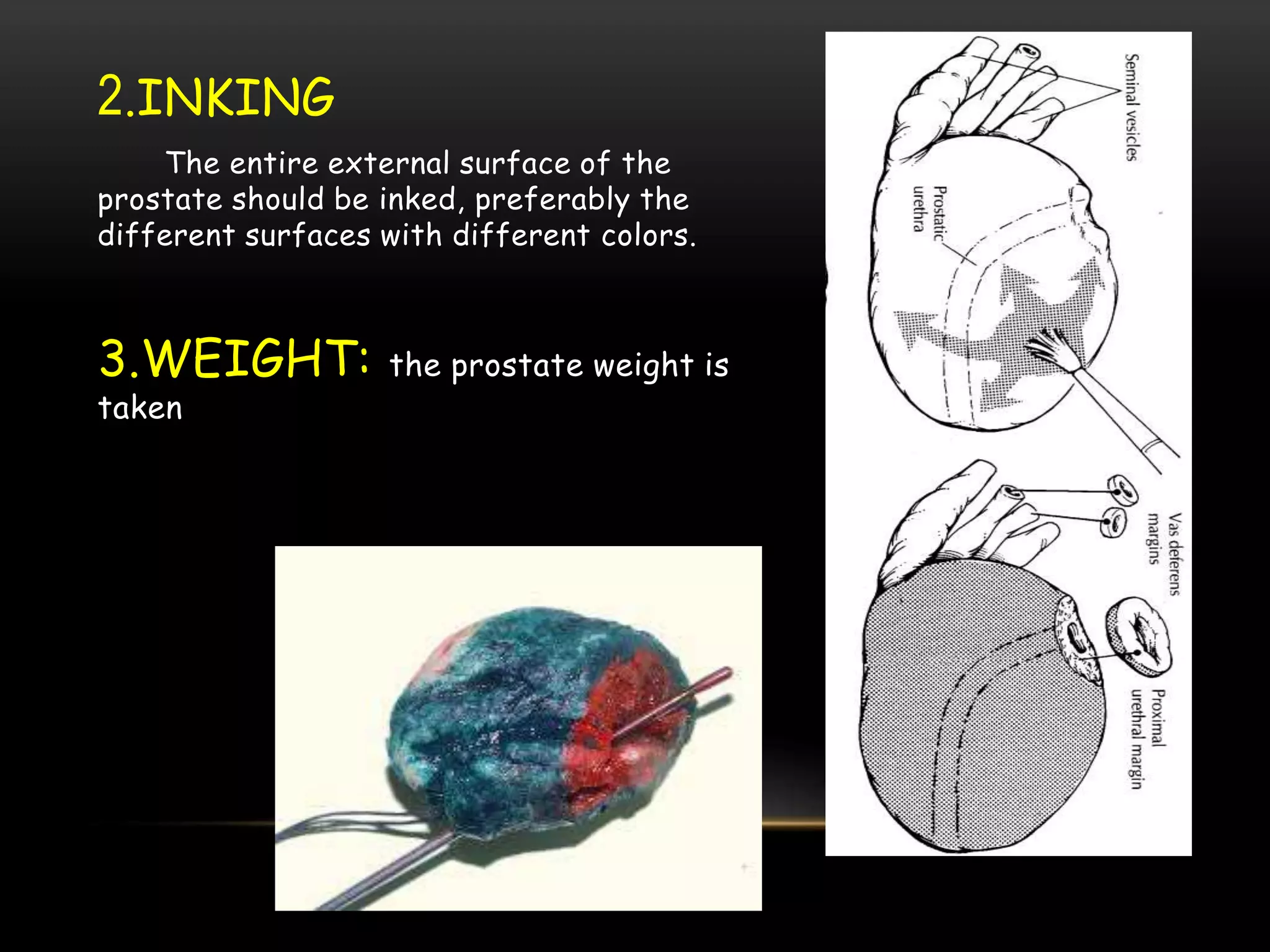 Prostate grossing and reporting | PPTX