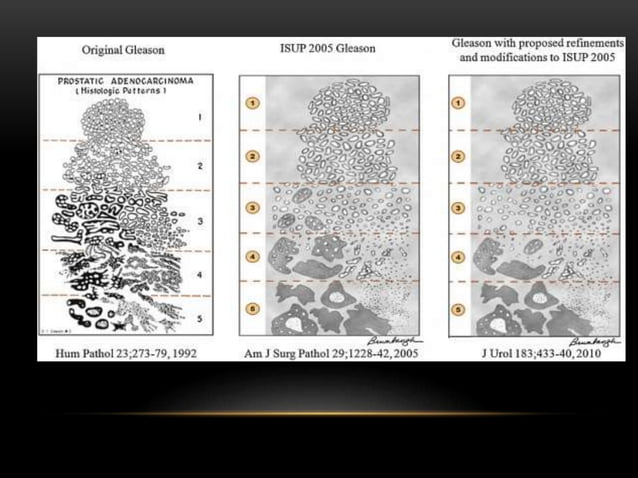 Prostate grossing and reporting | PPTX | Medical Health