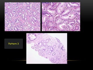 Prostate grossing and reporting | PPTX