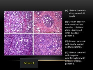 Prostate grossing and reporting | PPTX