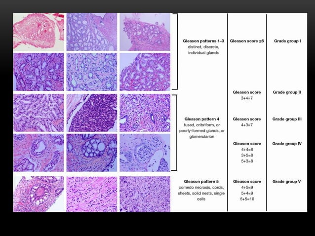 Prostate grossing and reporting | PPTX | Medical Health
