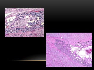Prostate grossing and reporting | PPTX