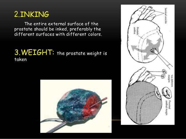 Prostate grossing and reporting