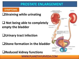 Prostate - Presentation | PPTX